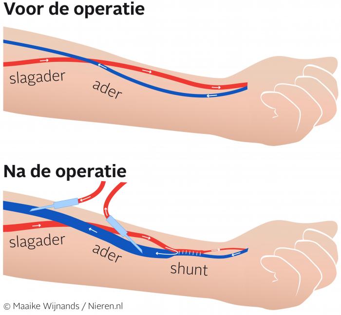 Aanleg van de shunt operatie